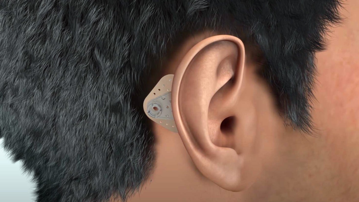 What Is a BAHA? | Dr Lynne Lim ENT Specialist